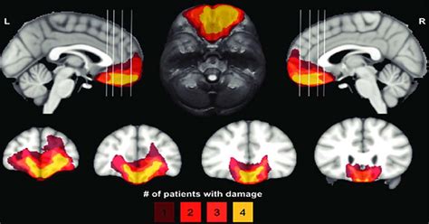Orbitofrontal Cortex Damage To This Brain Region Impairs Decision Making Https Debuglies Com