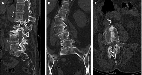 Coronal And Sagittal Deformity With Back Pain Adult Idiopathic