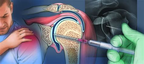 Arthrogram — The Interventional Initiative