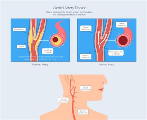Carotid Artery Disease Treatment Perth Dr Altaf