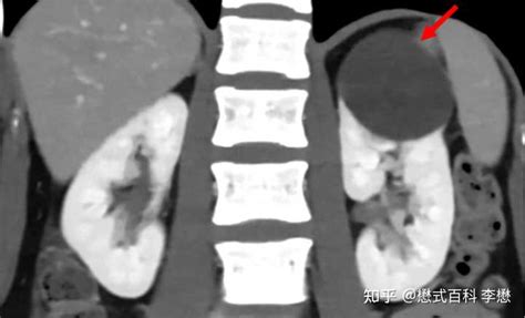肾部 Ct 能检查出什么疾病？ 知乎