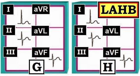 Ecg Interpretation Ecg Blog 203 Ecg Mp 20 21 — Axis And Hemiblocks