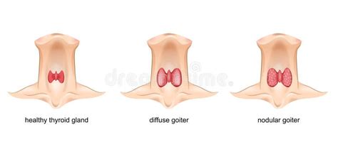 Goiter Thyroid Gland Stock Vector Illustration Of Endocrine 114924179