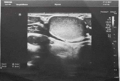 Neck Usg Performed At Age 22 Years Visible Cyst In The Suprasternal Download Scientific