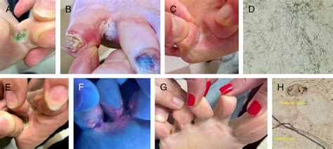 Toe Web Infections The Microbiome And Toe Web Psoriasis A Review Pmc