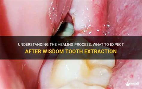 Understanding The Healing Process What To Expect After Wisdom Tooth Extraction Medshun