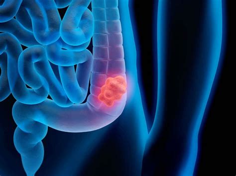 سرطان روده بزرگ علائم، علت و درمان ایران سرطان