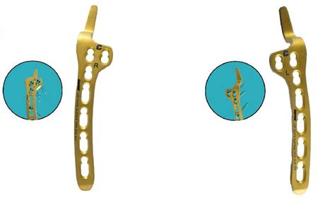 Lcp Clavicle Hook Plates Certification Iso Ce Fda Certification At Best Price In Delhi