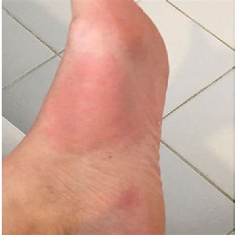 Annular Urticarial Rash On The Dorsa Of The Forearms Patient Nº 3 Download Scientific Diagram