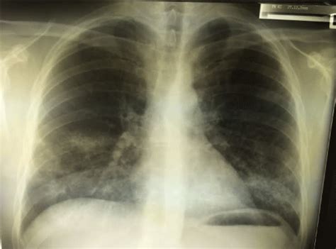 Diffuse Reticulonodular