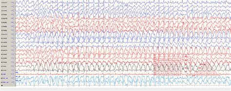 Abnormal Eeg Showing Non Convulsive Status Epilepticus Eeg