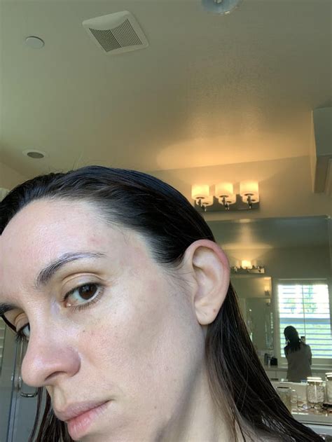 Hey D Im The Person Who Posted Their Horrid Eye Eczema I Thought Id Give An Update On How