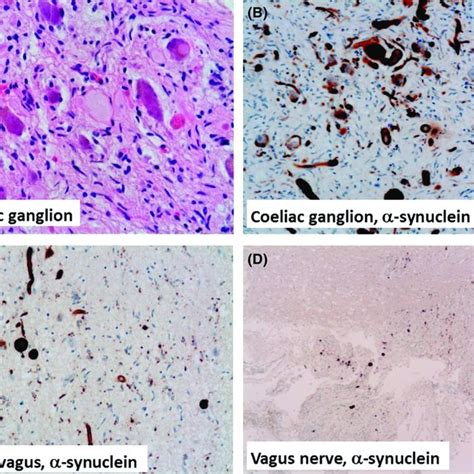 Postmortem Histology A The Celiac Ganglion Reveals Typical Lewy