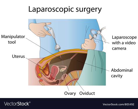 Schematic Laparoscopic Surgery Royalty Free Vector Image