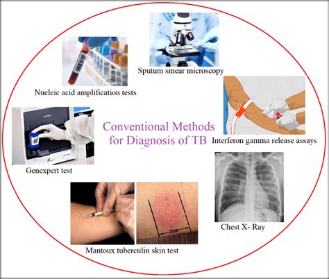 Conventional Methods For Diagnosis Of Tb Download Scientific Diagram