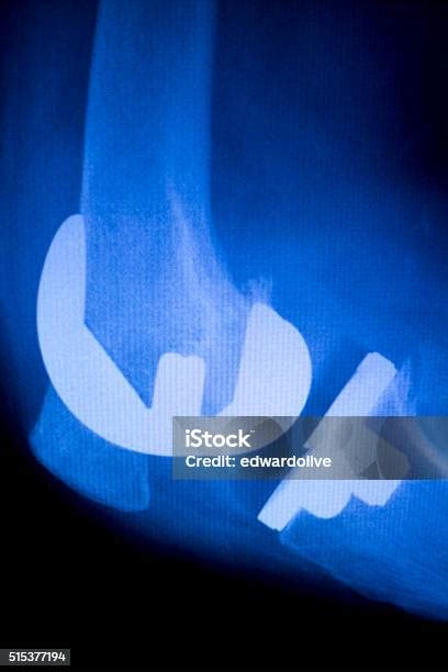 무릎 정형외과 임플란트 X선 검사 건강 진단에 대한 스톡 사진 및 기타 이미지 건강 진단 건강관리와 의술 과학 Istock