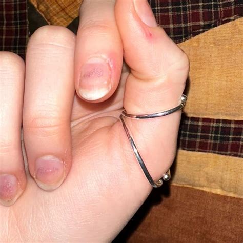 Arthritis Eds Finger Splint Adjustable For All Types Of Deviation