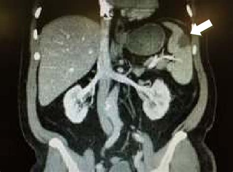 Splenic Rupture After Infective Endocarditis By Enterococcus Faecalis Case Report Semantic