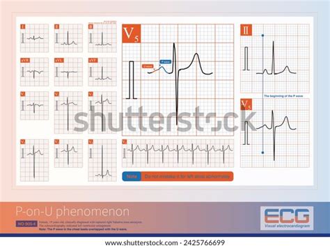 Sometimes When P Wave Overlaps Previous Stock Illustration 2425766699