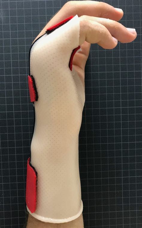 Fracture De Métacarpien Lorthesiste Fr