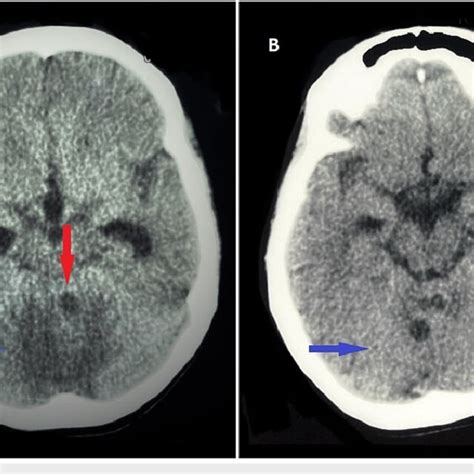 Ct Scan Of The Brain Plain A Axial View Showing Hypodense Lesion Download Scientific Diagram