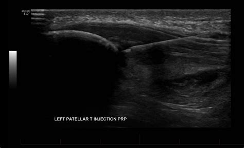 Peripheral Nerve Injections Melbourne Radiology Clinic