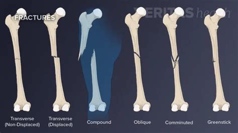 Fibula Fracture Types Causes And Treatment Options