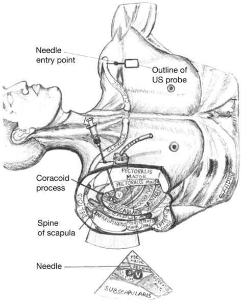 Infraclavicular Nerve Block