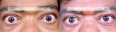 Thyroid Eye Disease Eyelid Retraction Surgery In India