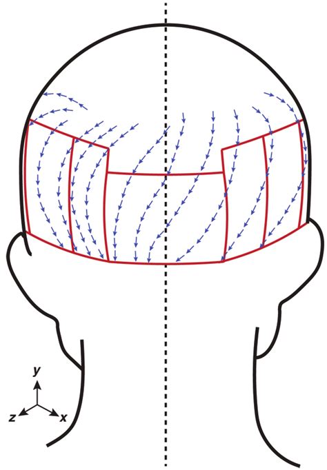 Vector Map Of Hair Growth Within The Donor Region Of The Scalp The