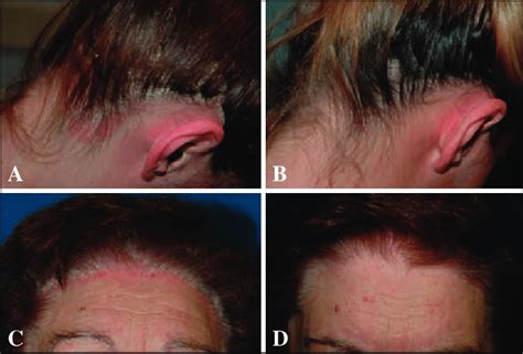 A Scalp Psoriasis Associated With Severe Itching And A Relevant Impact Download Scientific