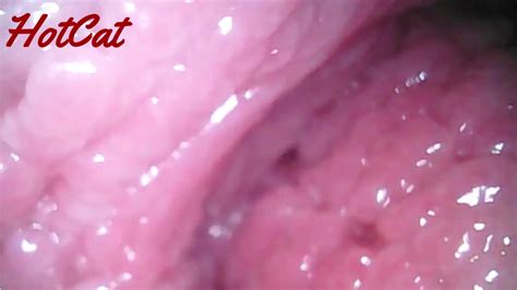 Endoscopic ♥vaginal Observation Free Sex Video Redtube
