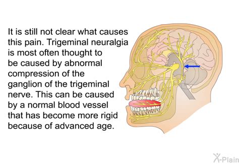 Trigeminal Neuralgia Radiofrequency Rhizotomy