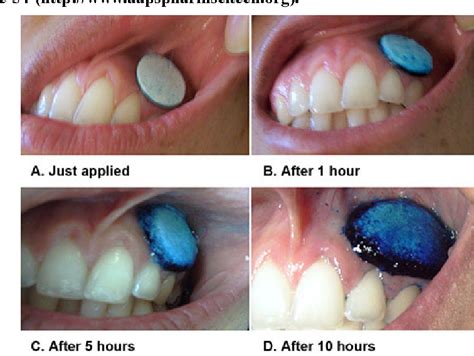 Figure 1 From Mucoadhesive Bilayered Tablets For Buccal Sustained Release Of Flurbiprofen