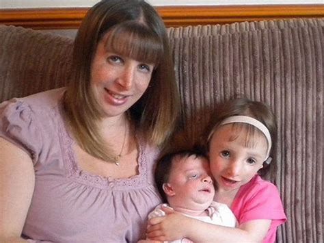 Celebrities With Treacher Collins Syndrome Captions Trend Today