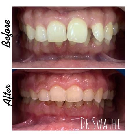 Dr Swathi Thattaliyath On Linkedin Skeletal Class 2 Adult Patient With