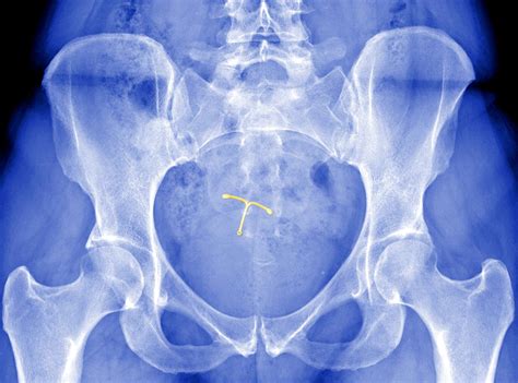 IUD Complications Ob Gyns Discuss Expulsion And Perforation SELF