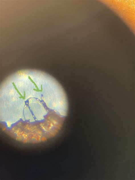 Scab With Hair And Mites Rmicroscopy