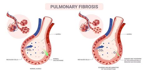 Pulmonary Fibrosis Alveoli Anatomy Vector Illustration Isolated On