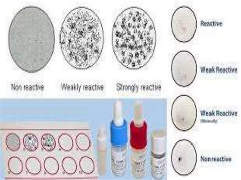 VDRL Test For Syphilis PPTX Infectious Diseases Diseases And Conditions