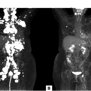 FDG PET Images Of Patient With EBV Diffuse Large B Cell Lymphoma Download Scientific