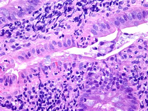 Pathology Outlines Inflammatory Polyp