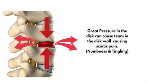 Decompression Table Therapy