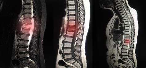 Compression Fracture Physical Therapy And Lumbar Exercises