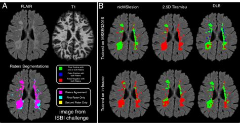 part a left axial sections of multi modal mri t1w and flair from