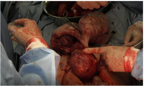 Intraoperative Findings Huge Fibroids Avulsed From Uterine Wall Download Scientific Diagram