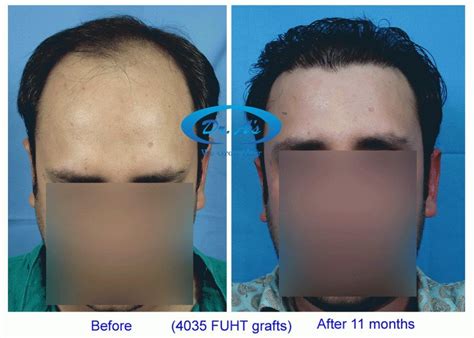Dr Arvind Poswal Hair Transplant India 33 Hair Restoration News Worldwide