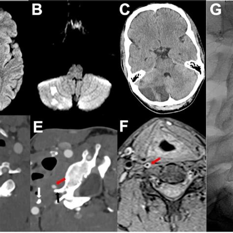 A B Diffusion Weighted Sequences Depict Right Thalamic Infarction