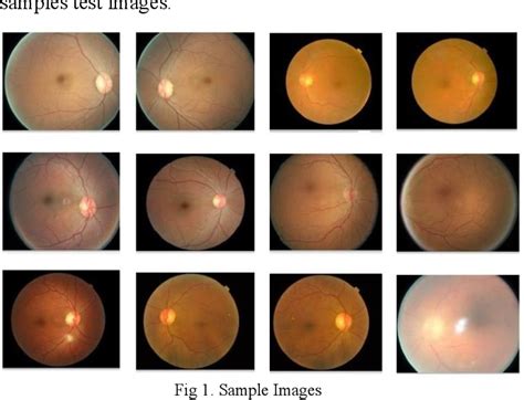 Figure 1 From An Intelligent Moth Flame Optimization With Inception Network For Diabetic