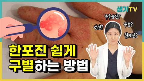 무좀 주부습진 건선과 헷갈리기 쉬운 한포진 감별법 Youtube